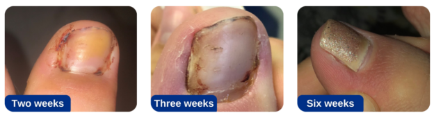 Nail surgery - Bradford District Care NHS Foundation Trust