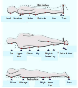 Pressure ulcers - guide for professionals - Bradford District Care NHS ...