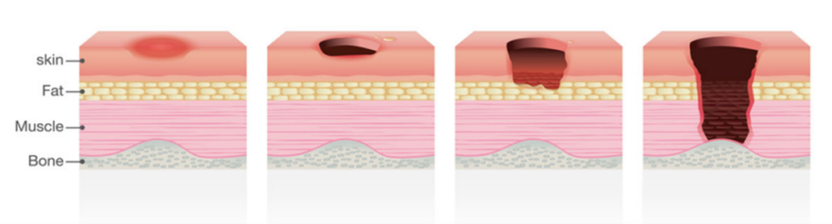 Pressure ulcers - guide for professionals - Bradford District Care NHS ...