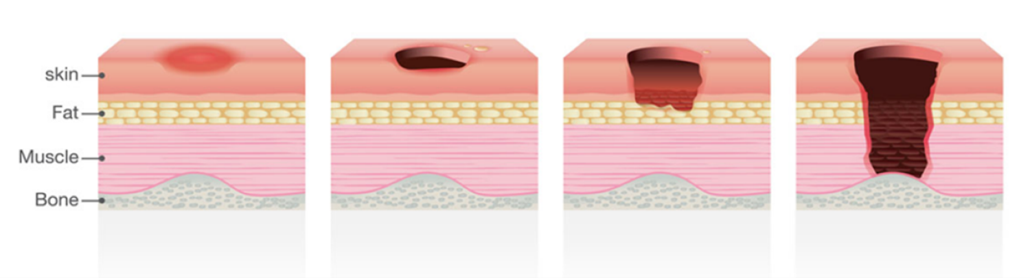 Pressure ulcers - guide for professionals - Bradford District Care NHS ...