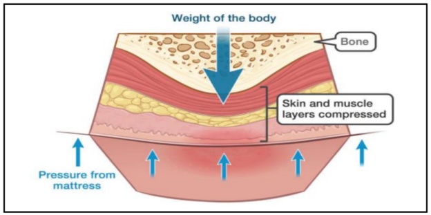 Pressure ulcers - guide for patients and carers - Bradford District ...