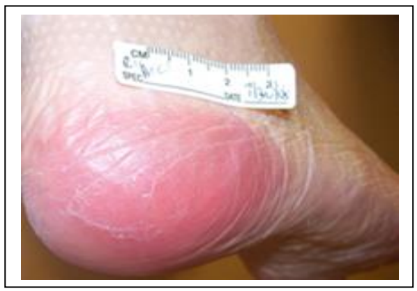 Pressure ulcers - guide for patients and carers - Bradford District ...
