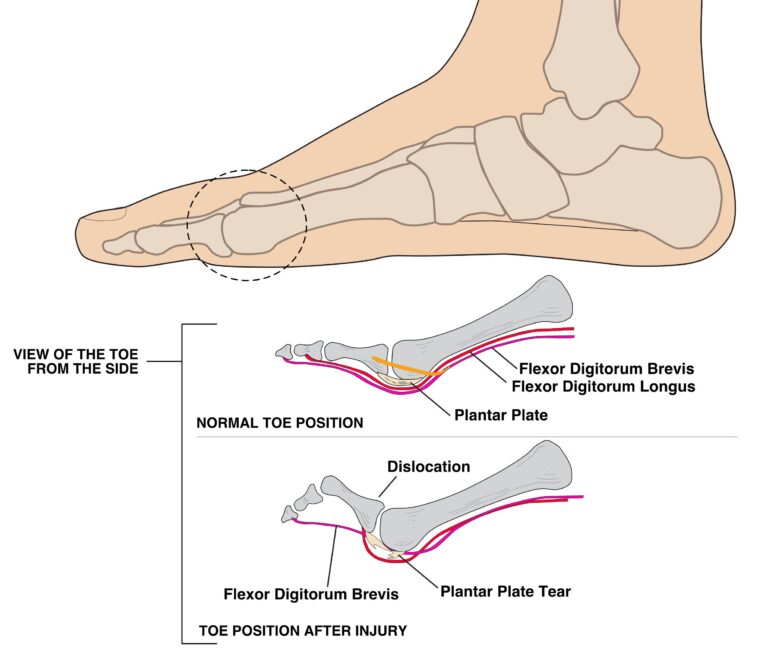 Pain in your toe or the ball of your foot - lesser toe deformities ...
