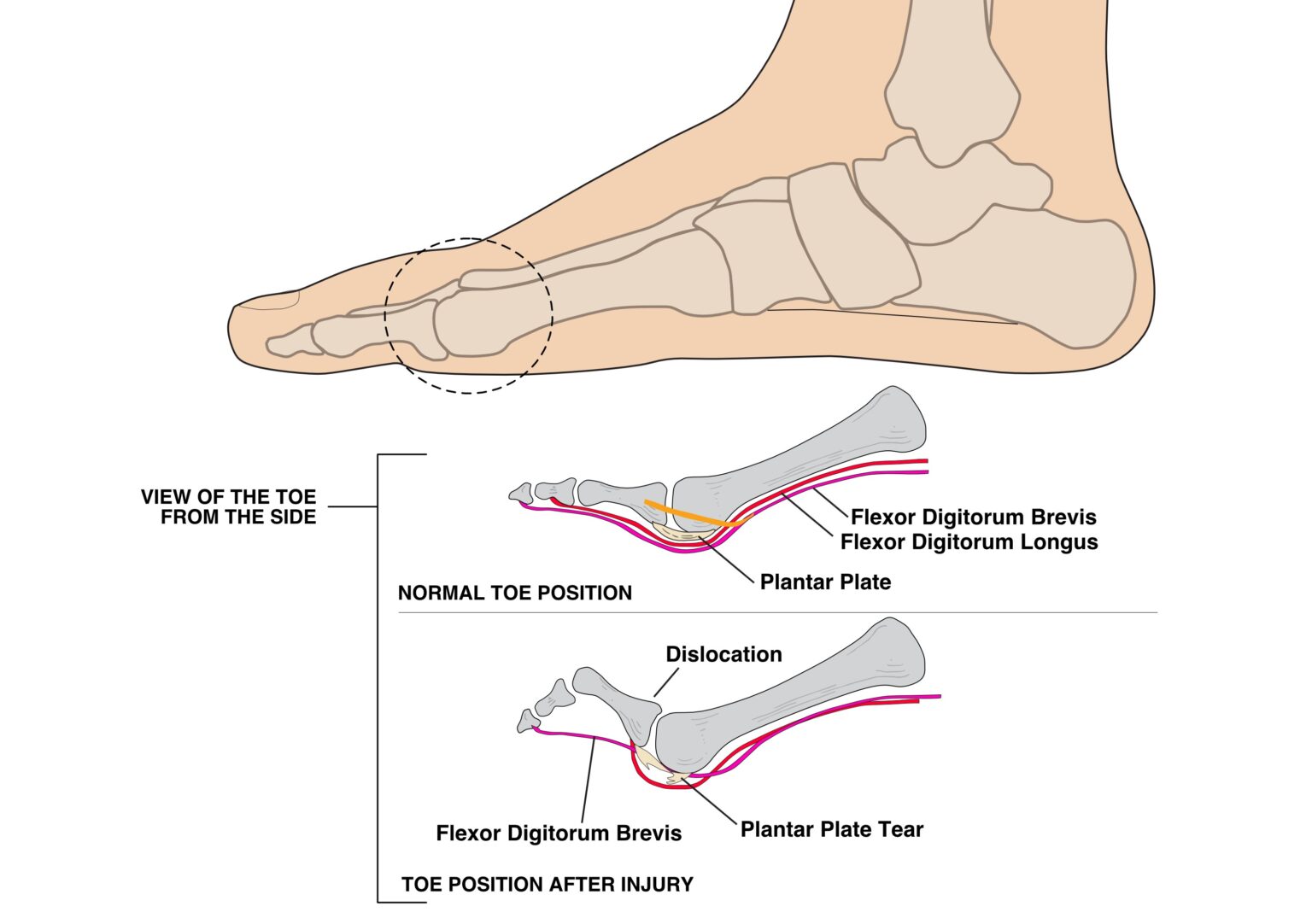 Pain in your toe or the ball of your foot - Metatarsalgia - Bradford ...