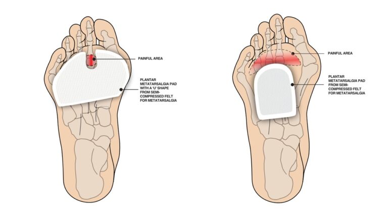 Pain in your toe or the ball of your foot - Metatarsalgia - Bradford ...