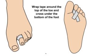 Pain in your toe or the ball of your foot - lesser toe deformities ...